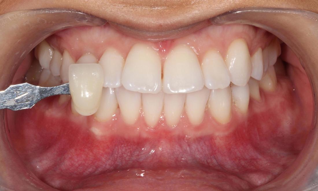 Kor Deep Bleaching System Before & After Photos | Los Alamitos California